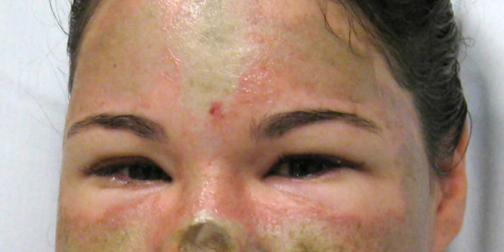 soap opera acid attack