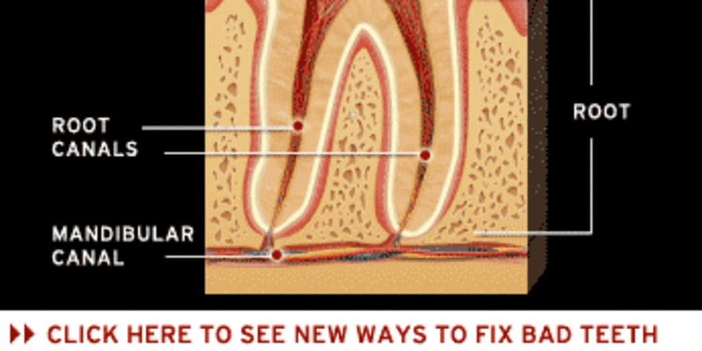 root canal without drilling