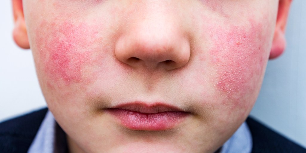 What Causes Fever Rash On The Lips Reddit 2023 - Infoupdate.org