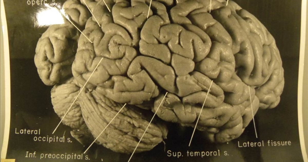 Uncovered photos of Einstein's brain reveal clues to his genius