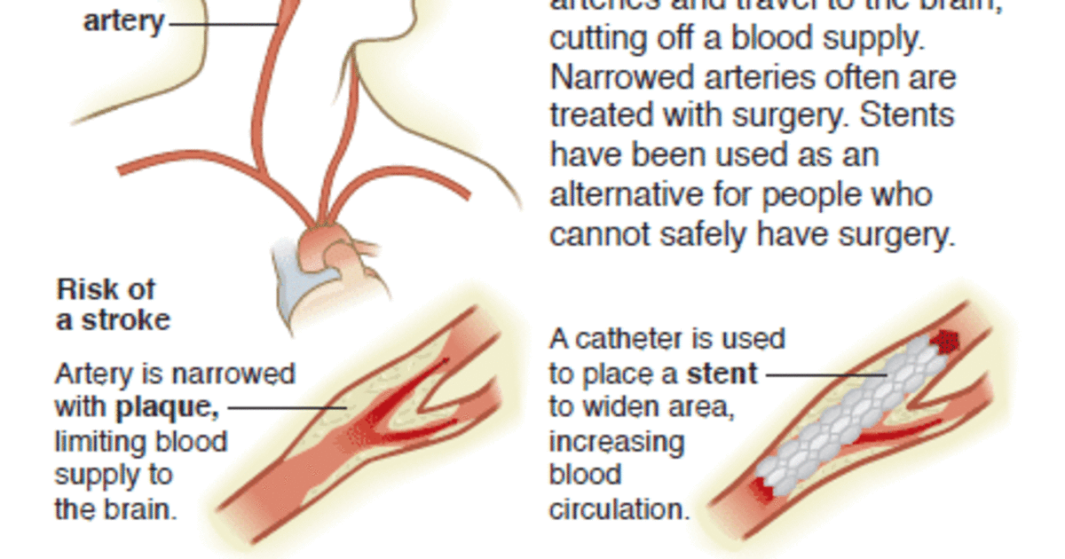 Neck stents safe, effective against strokes