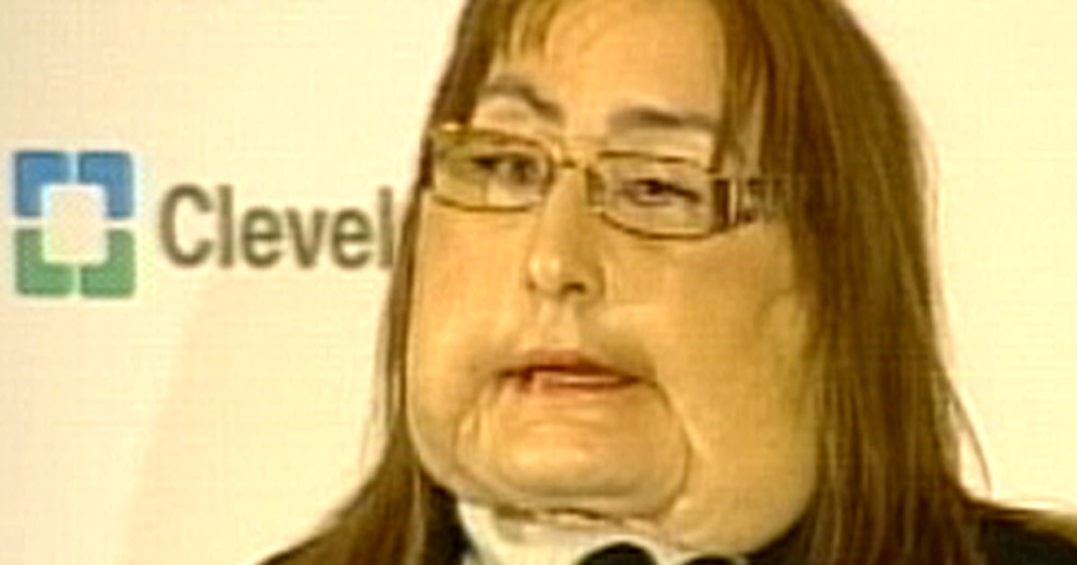Face transplant patient meets donor's family