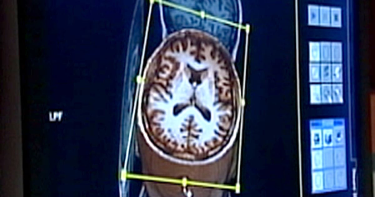 Brain scans show signs of autism