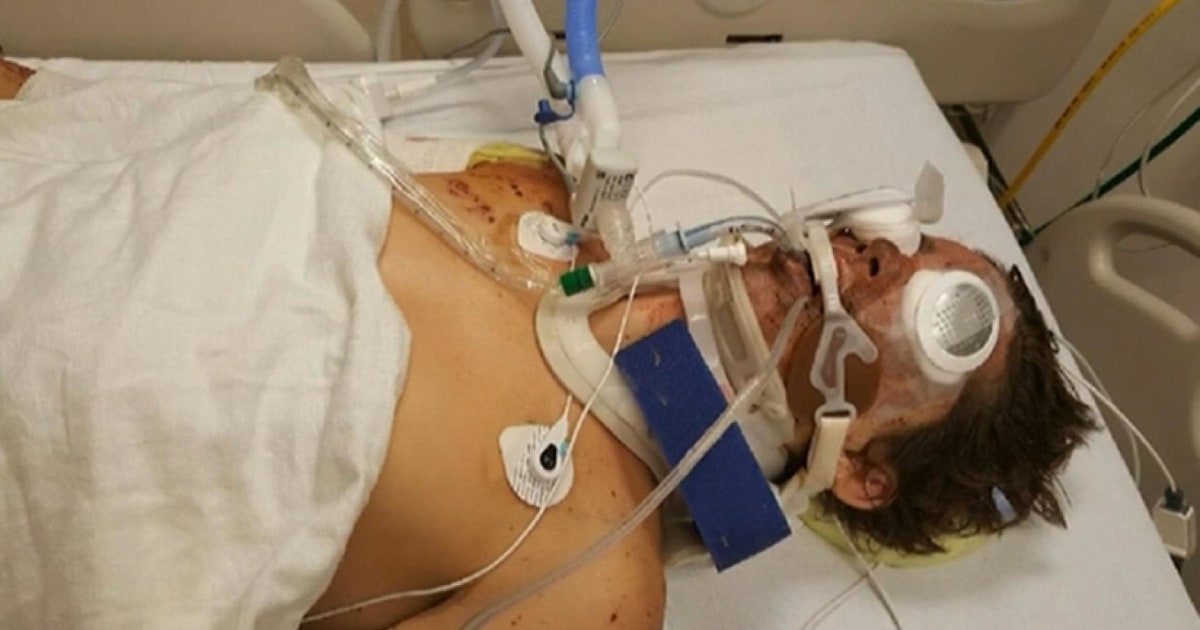 Sparkler Bomb Maims Texas Teen