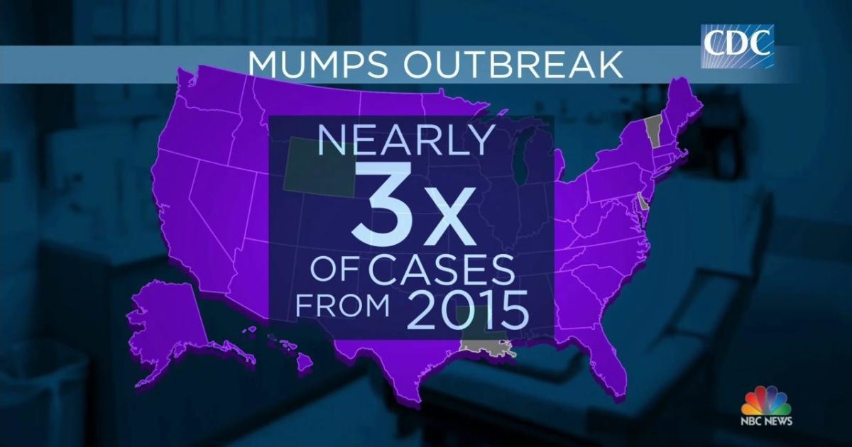 Mumps at 10-Year High in 2016, Says CDC