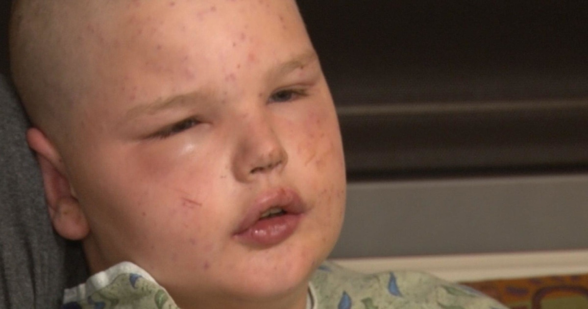 11-year-old stung by hundreds of "killer bees".