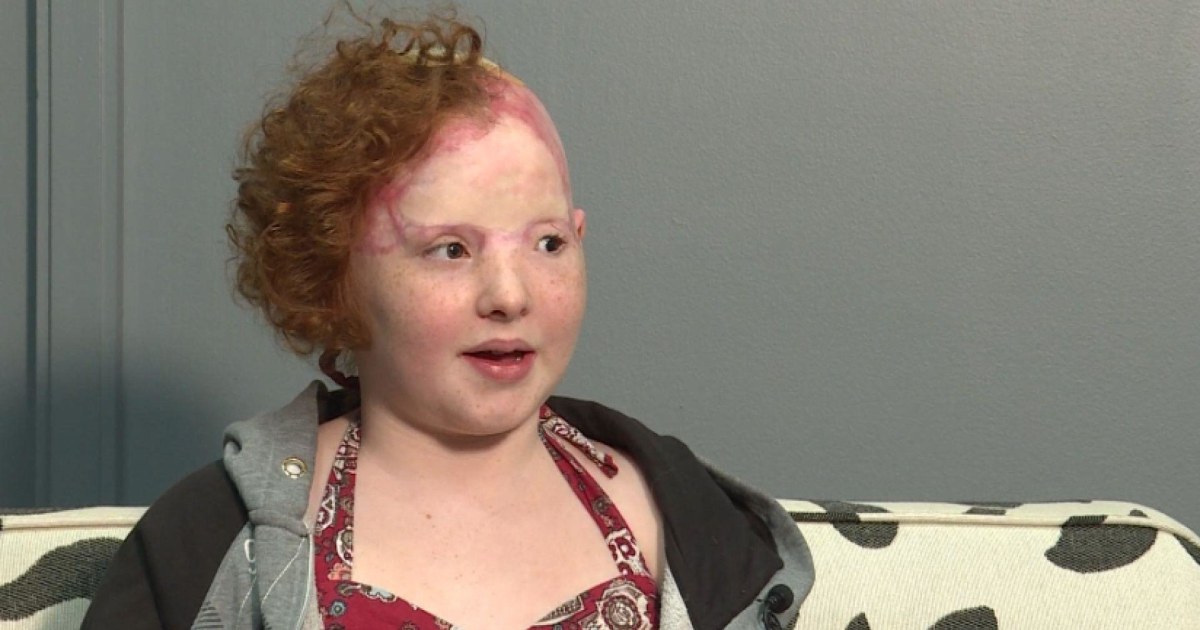 Girl Injured on Carnival Ride: 'My Scars Don't Define Me'