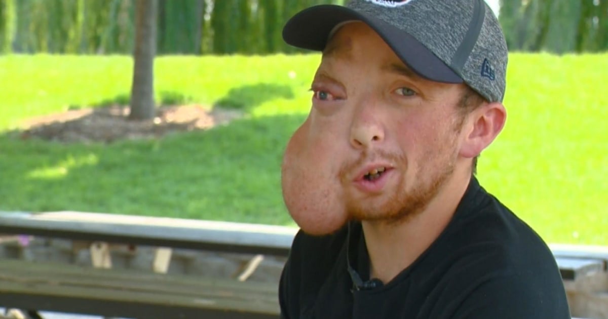 Outpouring of Support For Man With Painful Tumor