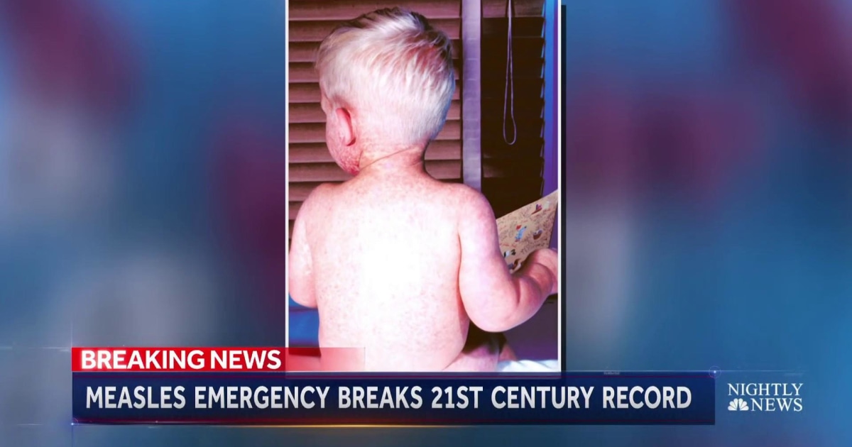 Measles cases hit record high for this century