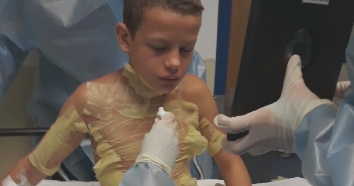 12-year-old Michigan boy burned in 'fire challenge'