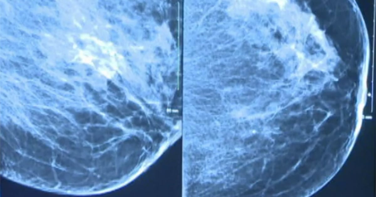 3D Mammograms Helping Save Lives