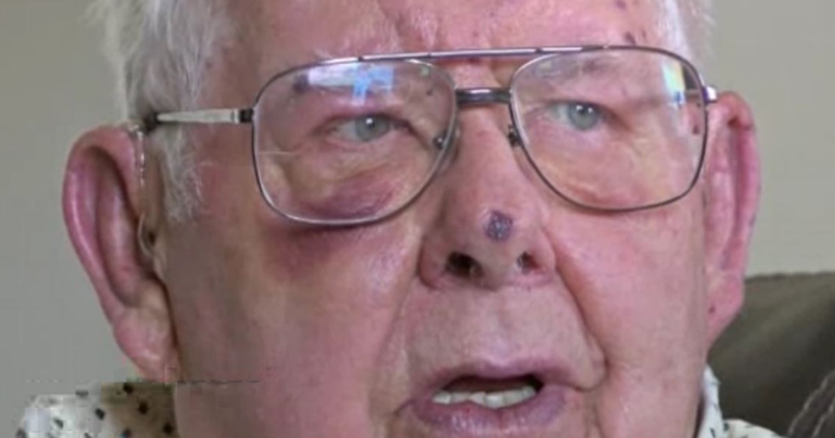 89-Year-Old Man Survives Hundreds of Bee Stings