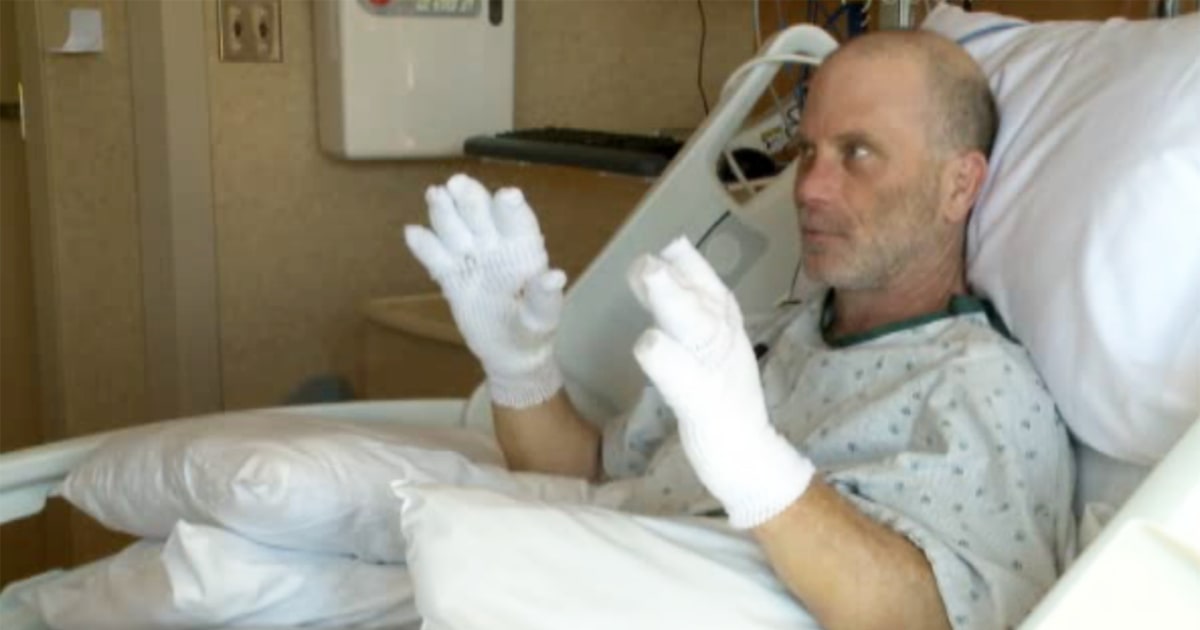 Frostbite cases surge