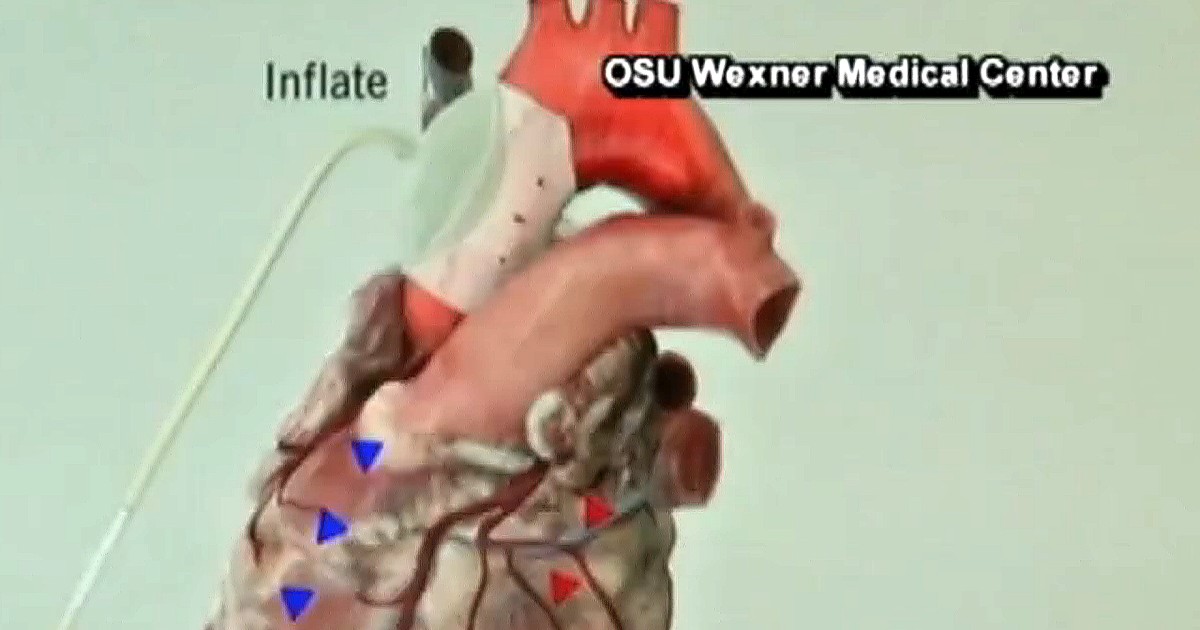 New Device Aids Ailing Hearts