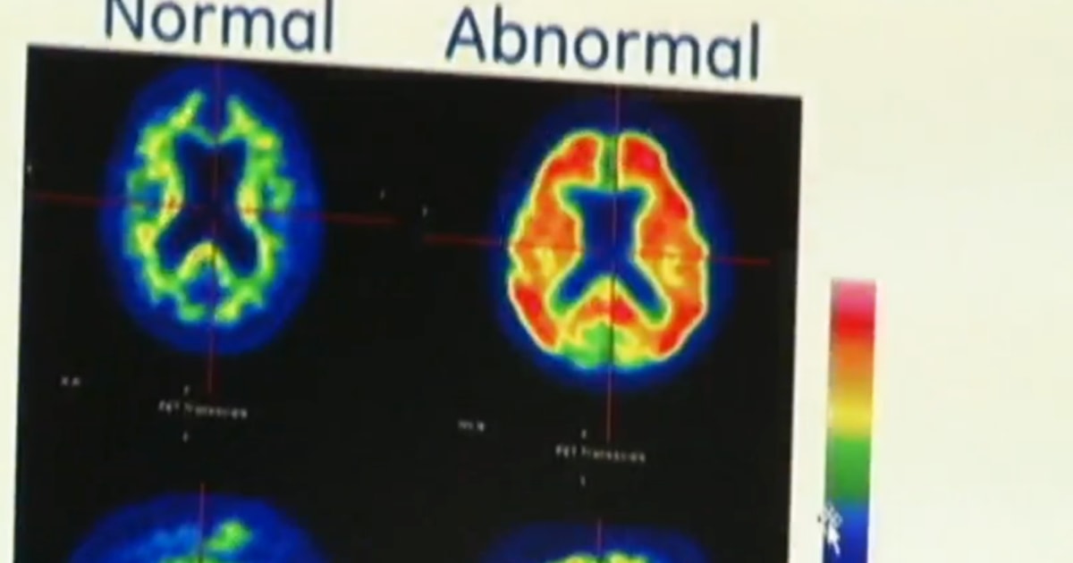 New Drug May Help Slowing Down Alzheimers