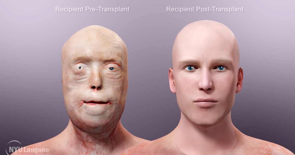 Medical Animation Details Face Transplant Surgery at NYU