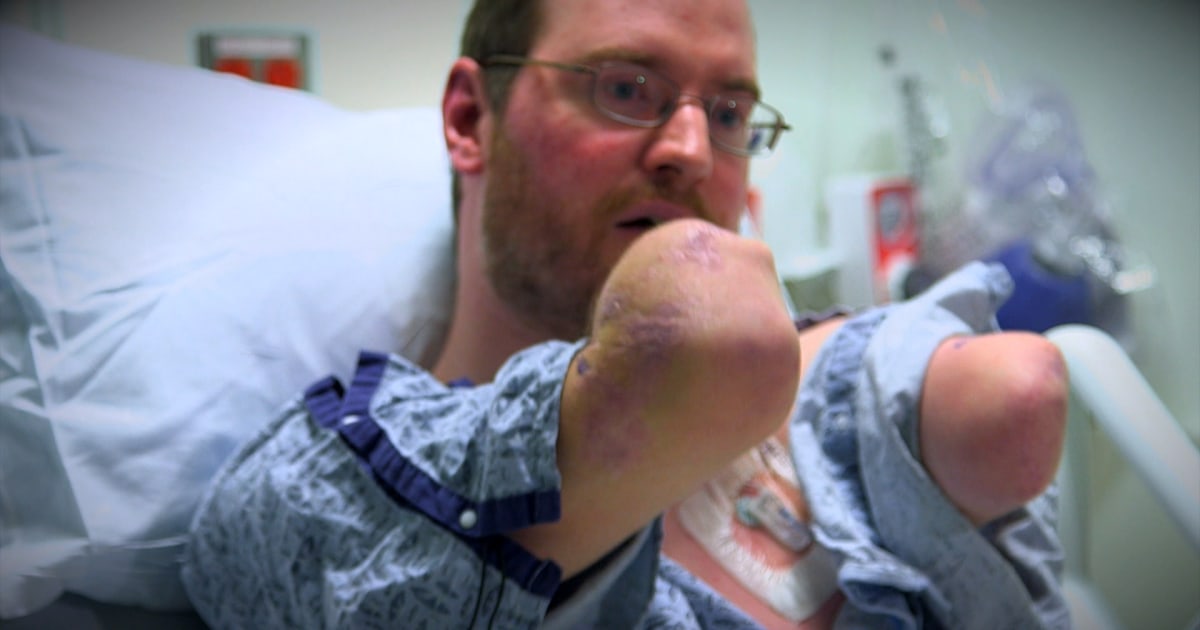 Watch Patient Prepare for Bilateral Arm Transplant