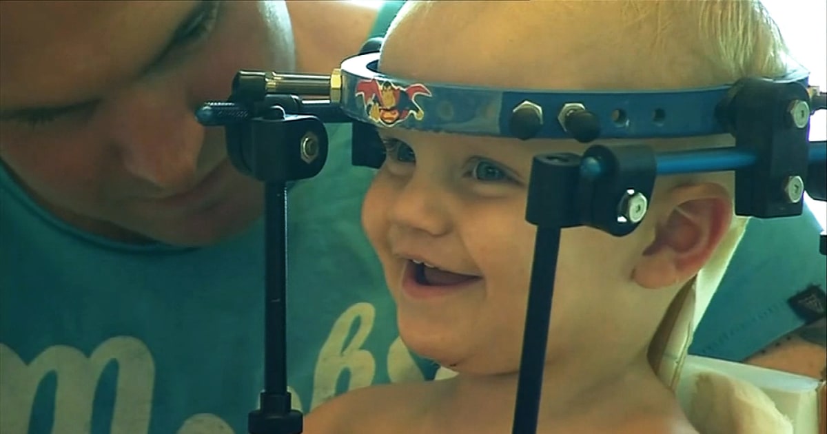 Surgeons Reattach Toddler's Head After Internal Decapitation