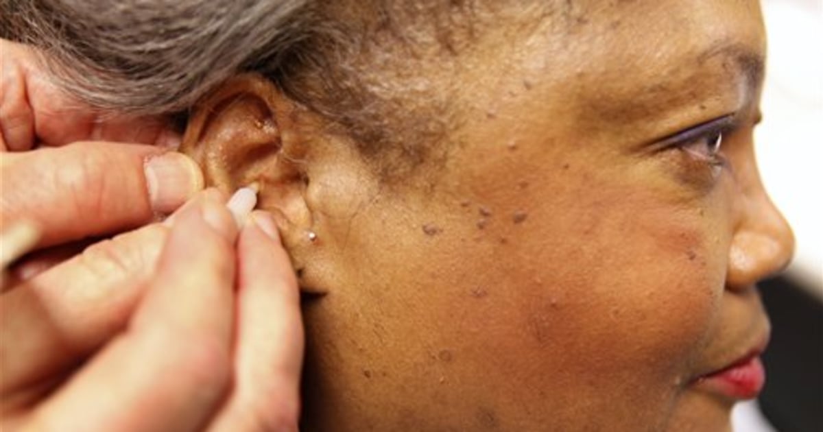 Air Force trains combat docs in acupuncture