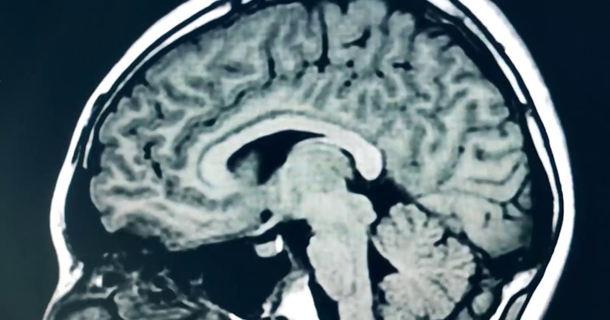 Covid attacking the brain may explain long-lasting symptoms