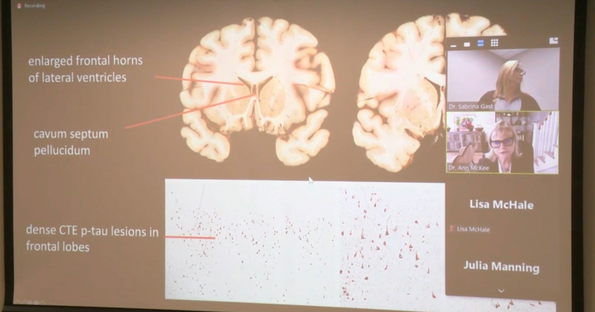 Officials announce former NFL player Phillip Adams had CTE at time of ...