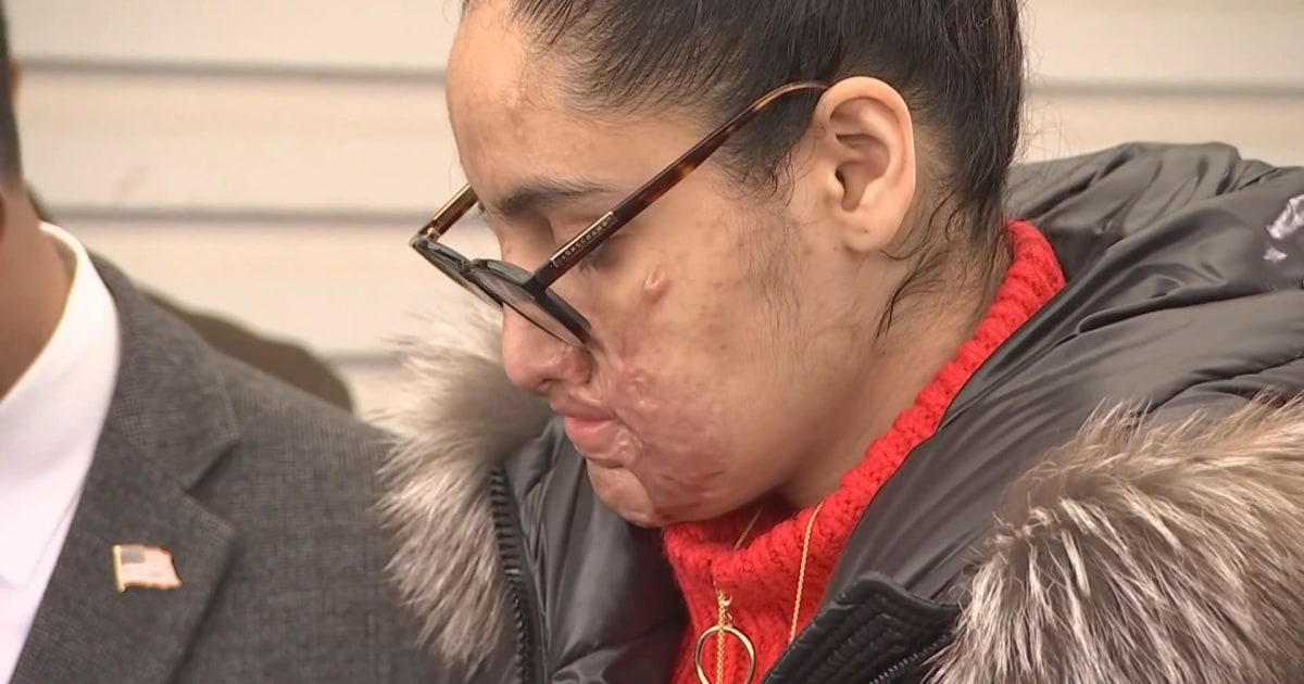 Family of acid attack victim hopes search continues for suspect