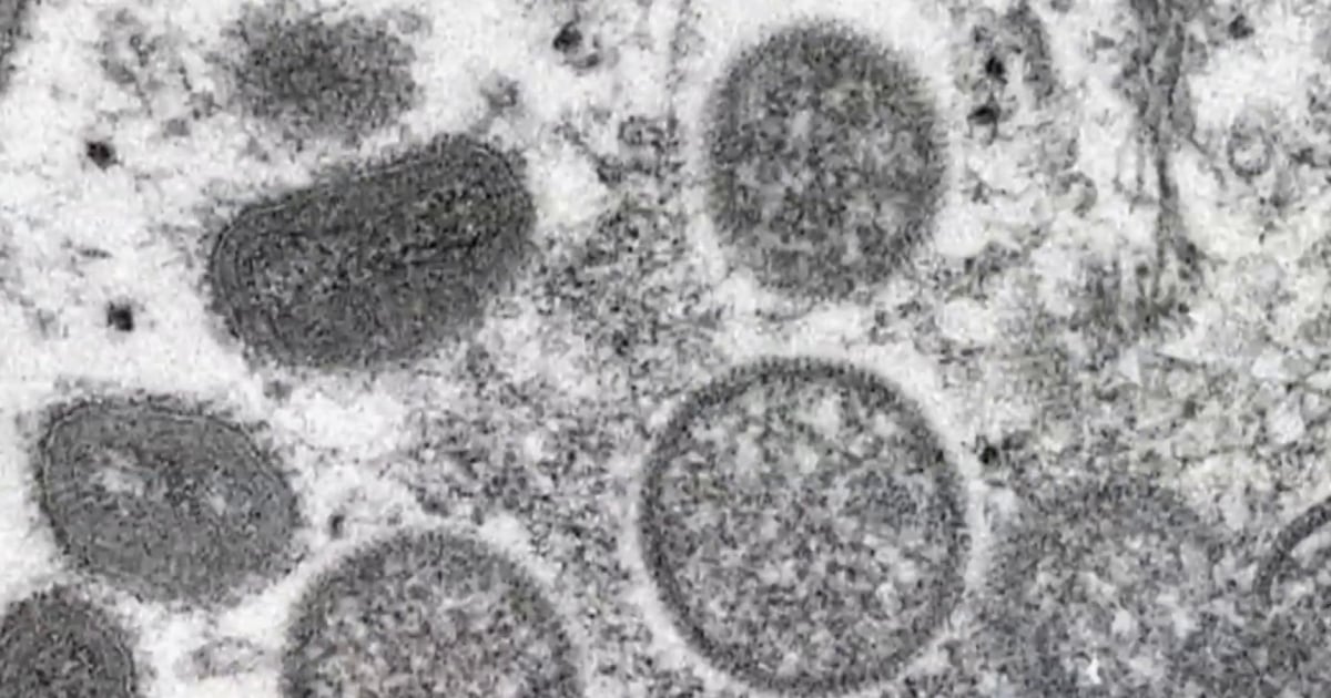 WHO declares monkeypox a global health emergency as cases skyrocket