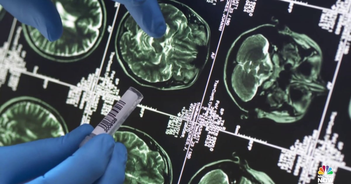 Experts unsure about use of at-home brain zapping treatments