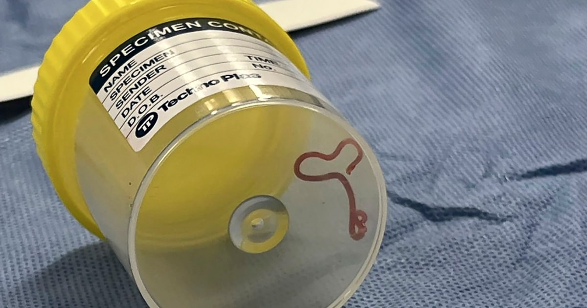 Surgeon extracts live worm from patient's brain