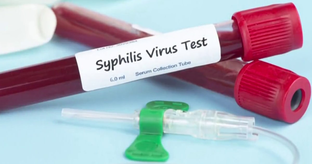 Syphilis rates in the U.S. up 80% since 2018
