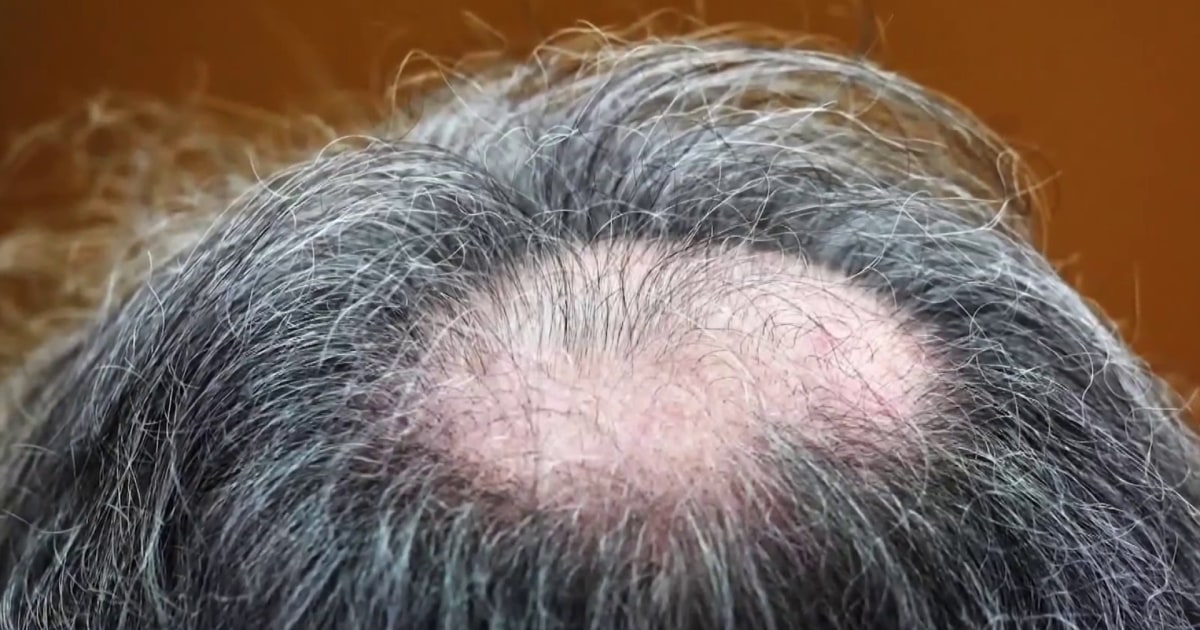 Some doctors are worried about rare side effects from hair loss drug
