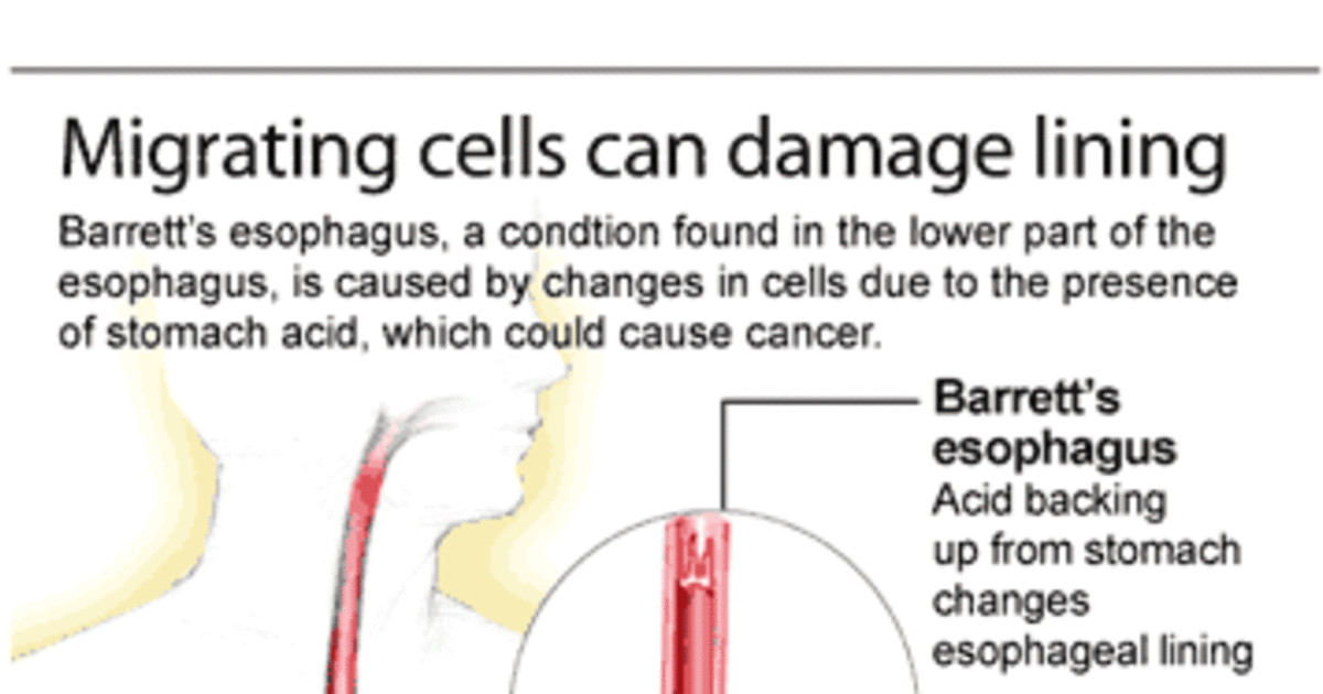 Heartburn fuels spike in esophageal cancer