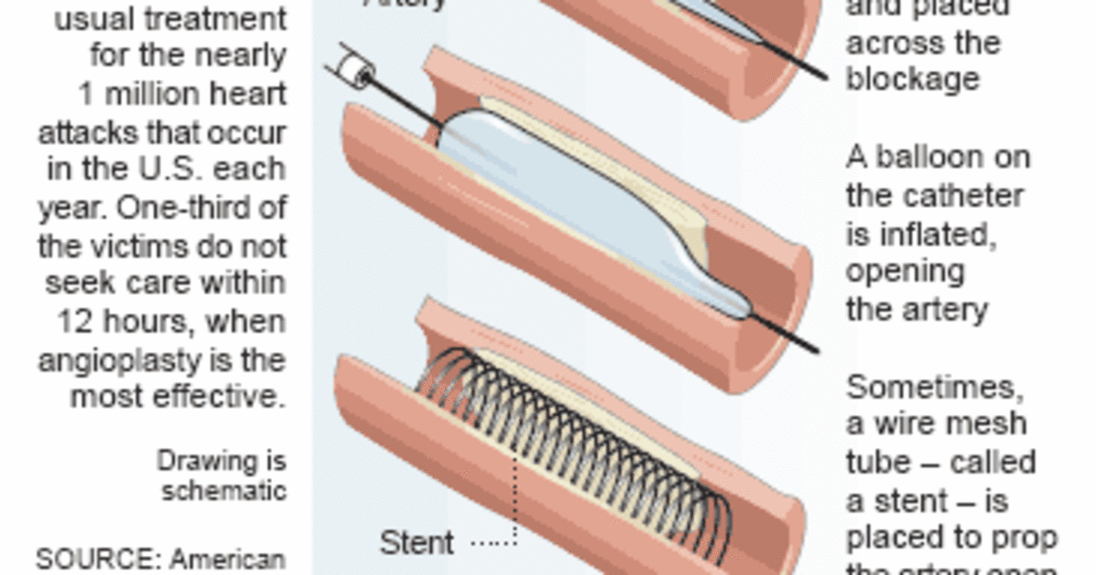 Opening blocked arteries not always good idea