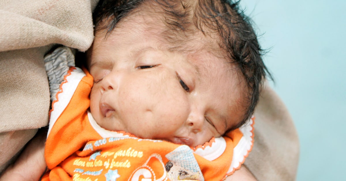 Two-faced baby's family refuses special care