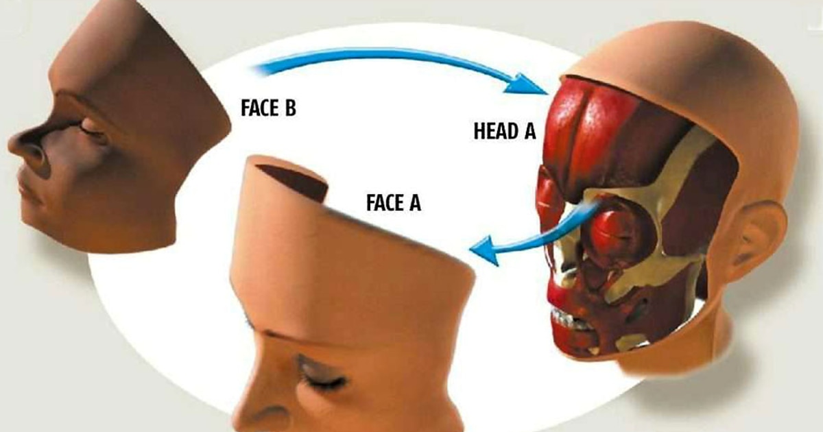 Face-off over facial transplants