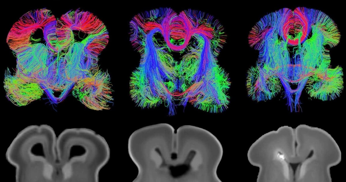 Maps of Unborn Human Brains Point to Medical Frontiers