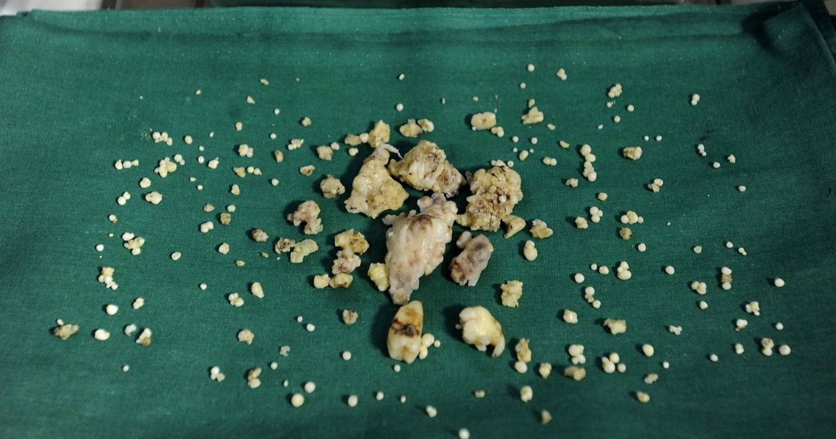 'Unexpected': Dentist's Surprise at Teen's 232 Teeth