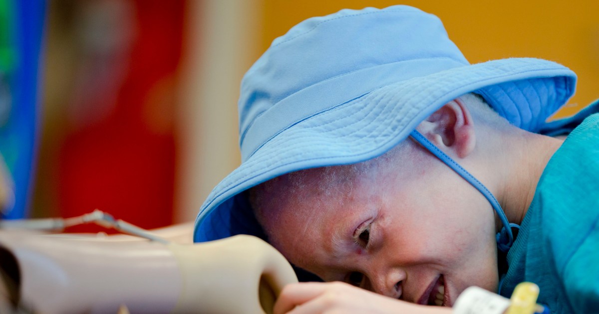 Young Albino Amputees Get Second Chance With New Limbs