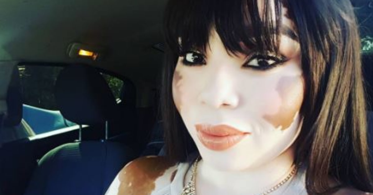 Life With Vitiligo Inspires Advocate's Quest for Broader Acceptance