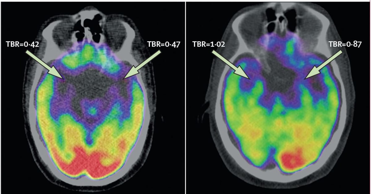 Here's How Stress Might Cause Heart Attacks, Strokes