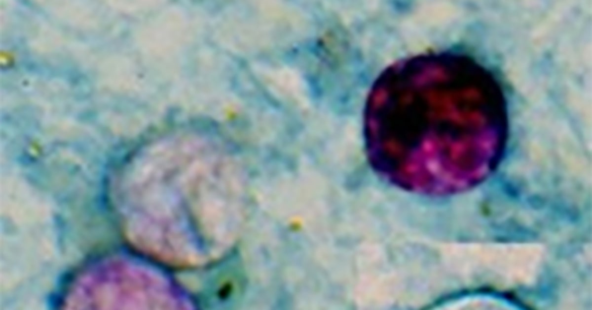 61 sick in parasite outbreak linked to McDonald's salads