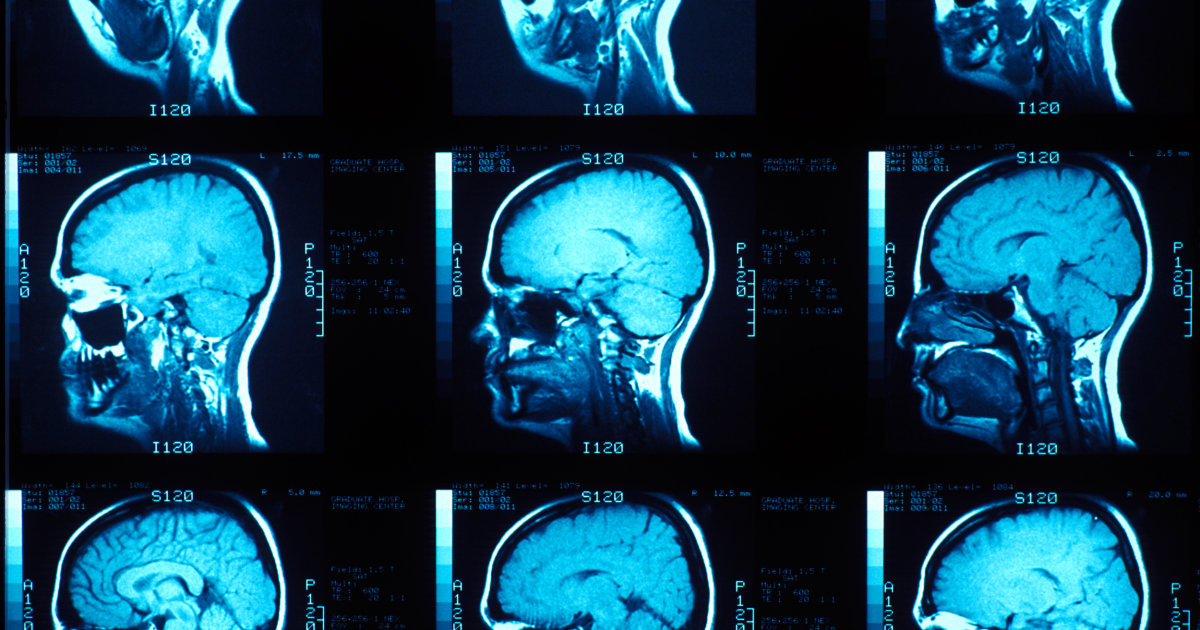 Being Poor Affects Kids' Brains, Study Finds