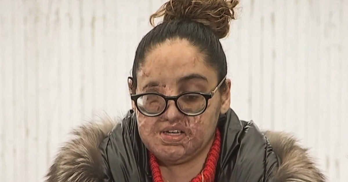 N.Y. college student burned in suspected acid attack criticizes police ...