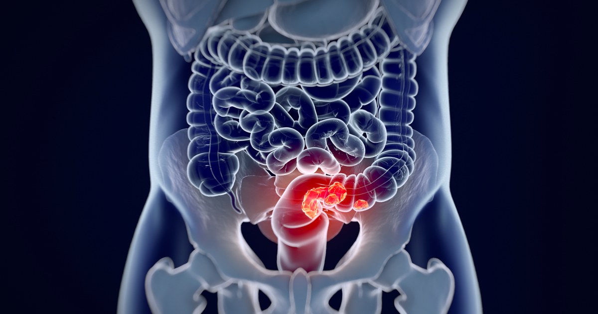 Un doctor habla del estudio para tratar cáncer de recto que trae esperanza