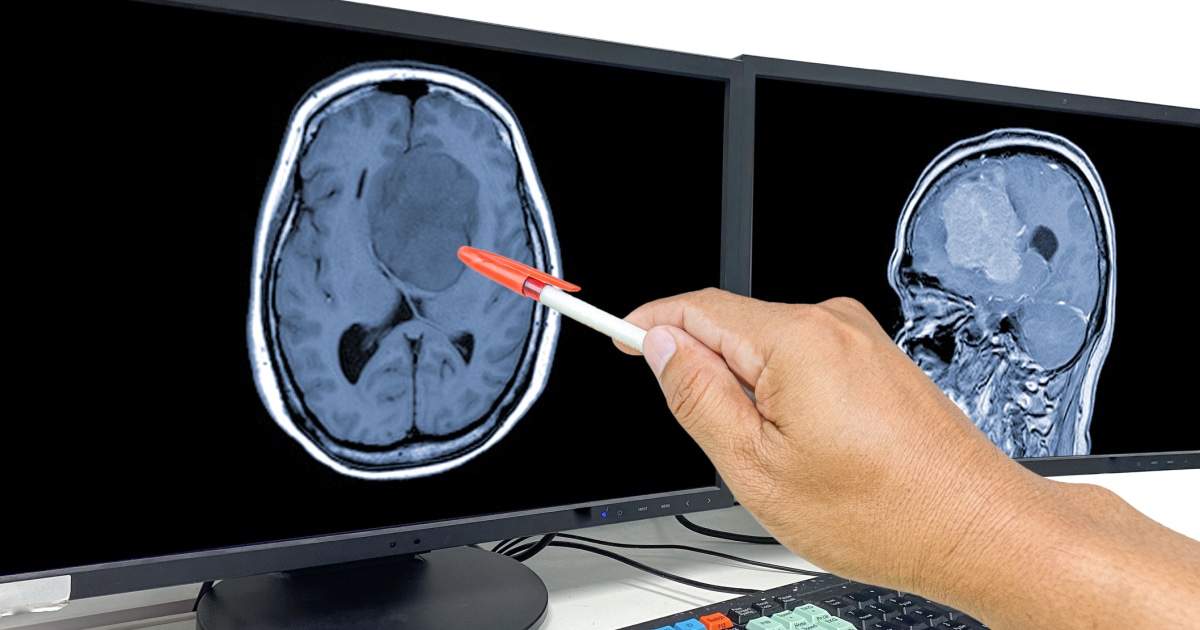 Le diagnosticaron cáncer cerebral y le dieron 6 meses de vida. Lleva 6 ...