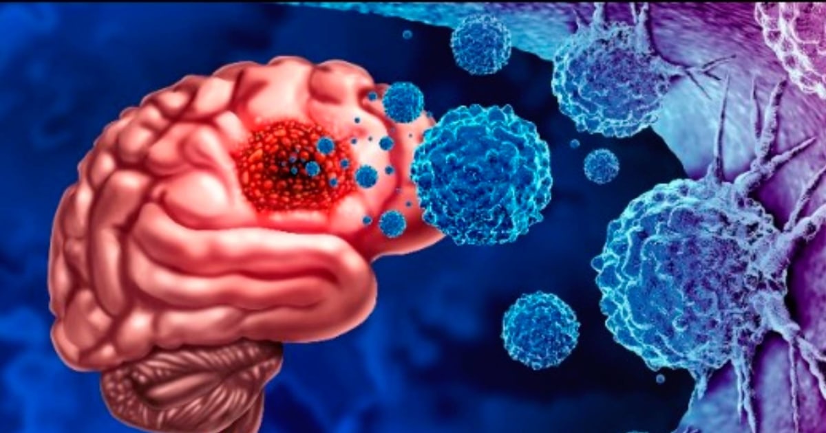 Nuevo tratamiento contra el cáncer cerebral logra reducir tamaño de tumor