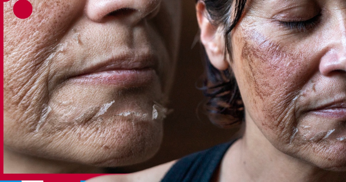 El 'peeling' con fenol: en qué consiste y lo que recomiendan los expertos