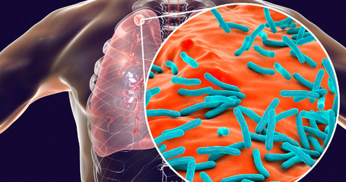 Tuberculosis: Brote de 70 casos en Kansas City deja dos muertos