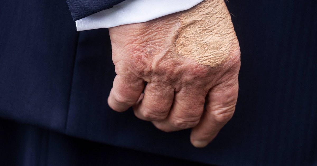 What is chronic venous insufficiency, Trump's diagnosis?