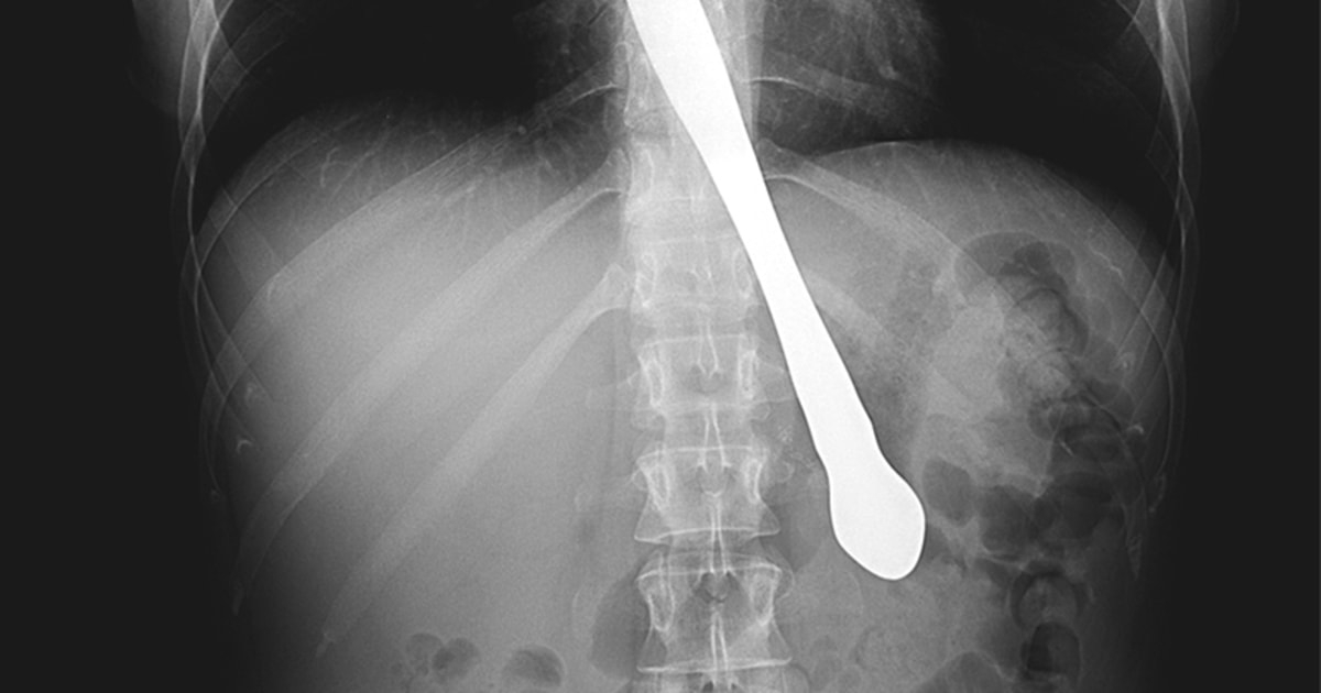 Here's what it looks like if you swallow a knife